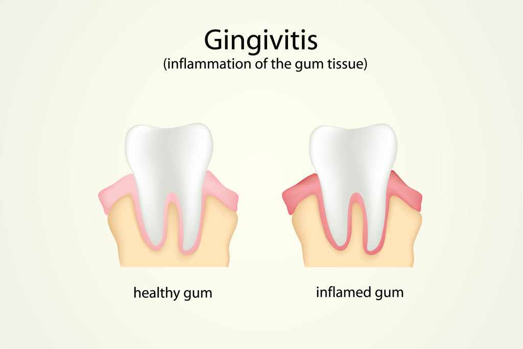 Gingivitis (Gum Inflammation) - Causes, Symptoms and Treatment